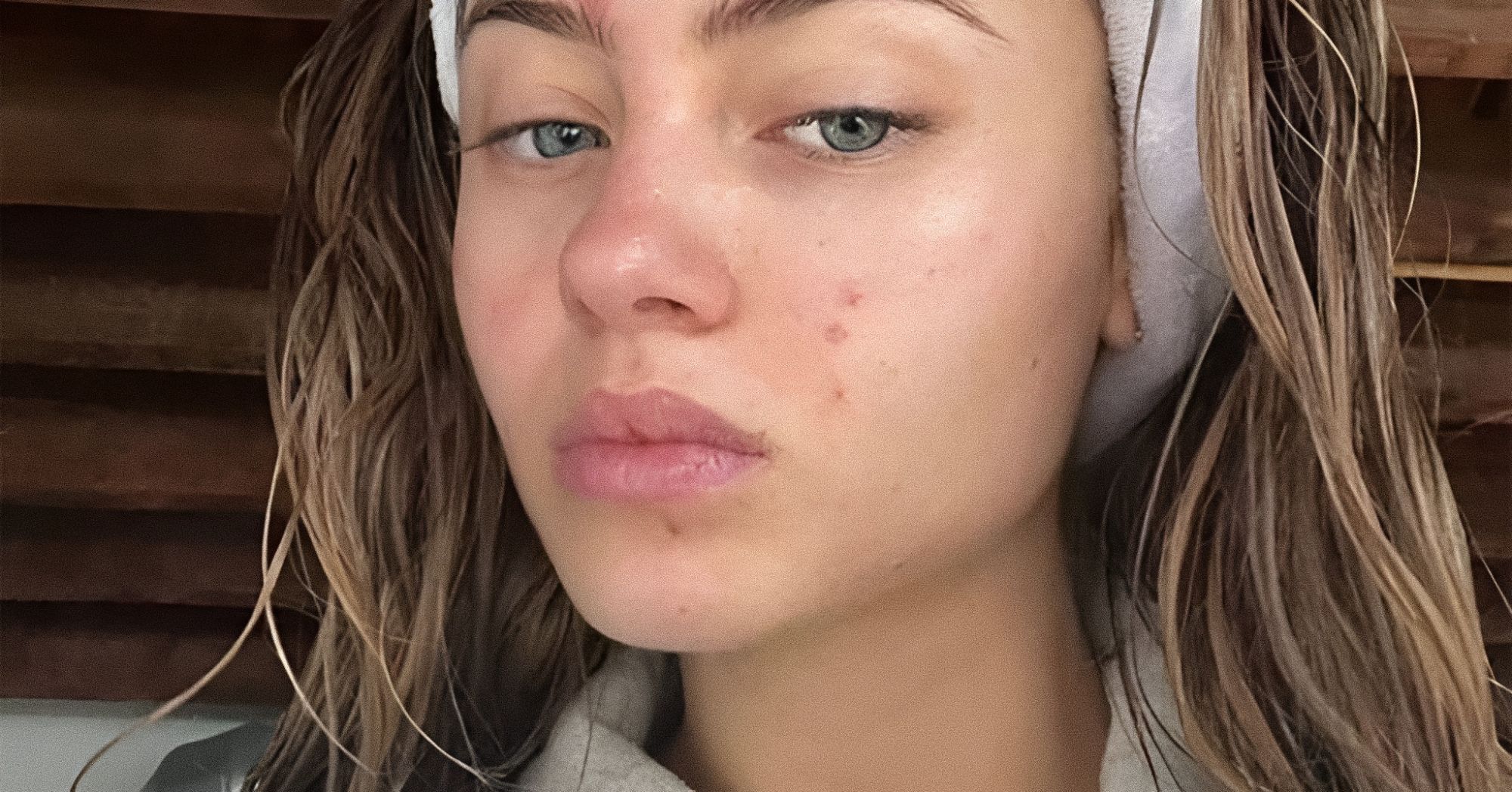 Skin purging: what it is, how long it lasts, and how to manage it - nss ...